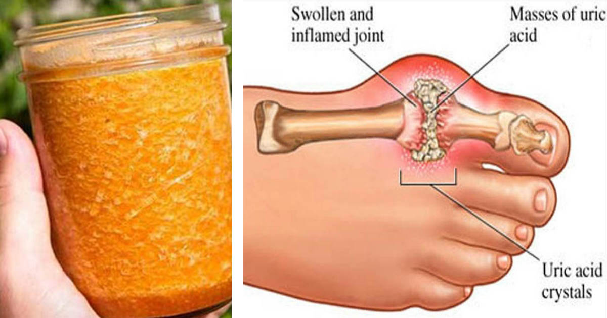 Cure Gout Forever By Using This Natural Treatment Healthy Natural