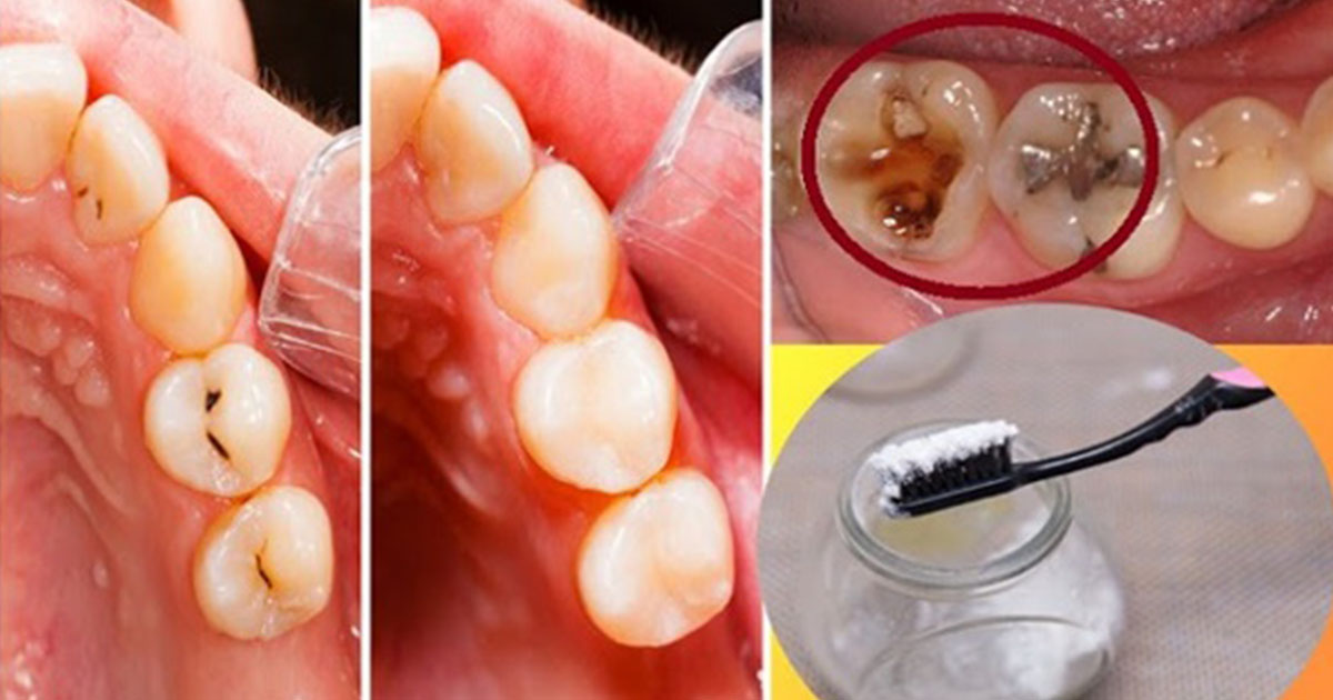 4 Basic Steps That Will Easily Remove Your Cavities! - Healthy Natural ...
