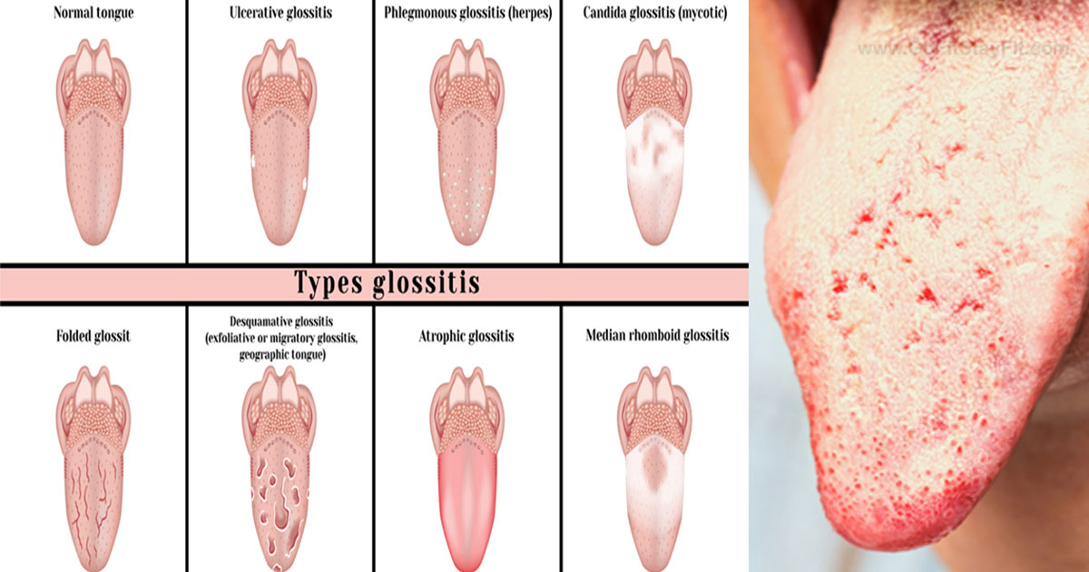 7 Warning Signs Your Tongue May Be Sending - Healthy Natural Solution