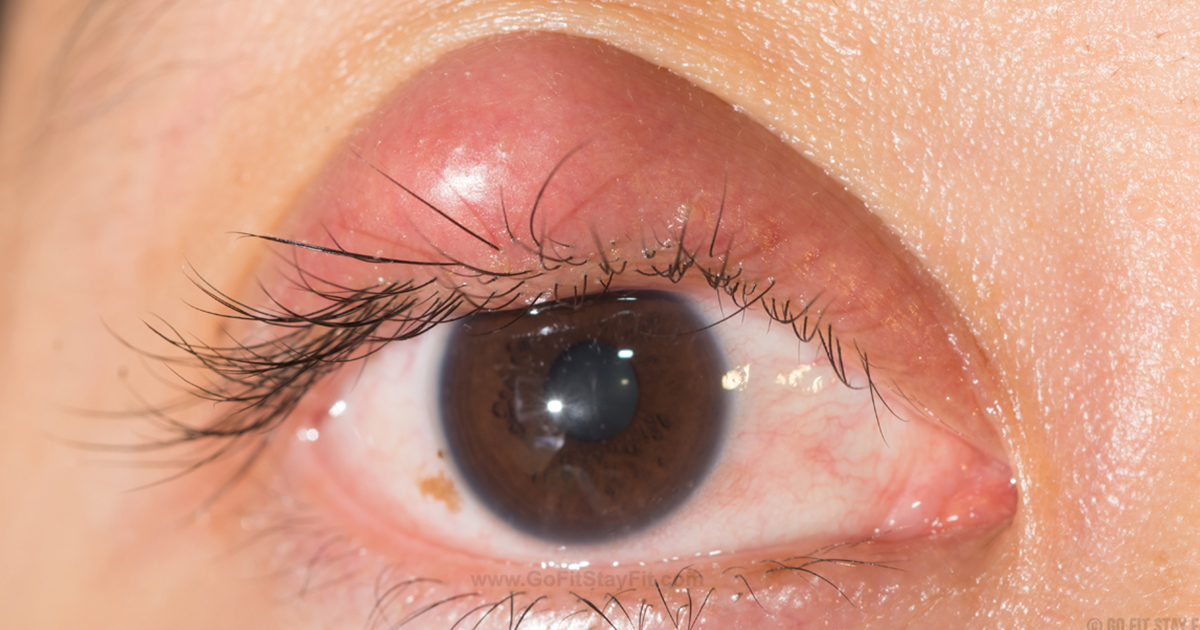 Easy and Safe Ways to Get Rid of Styes Fast at Home - Healthy Natural ...